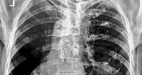 Fieggentrio: Erwtenplantje groeit in longen van een man.