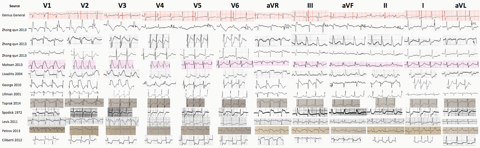 Two EKG patterns of pulmonary embolism which mimic MI