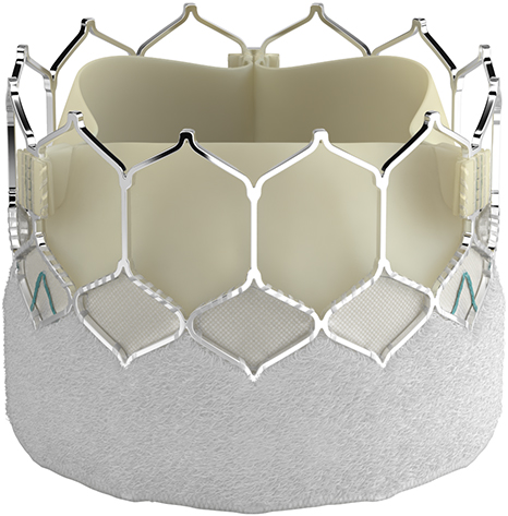 VÁLVULA ULTRA TRANSCATÉTER SAPIEN 3 DE EDWARDS PARA LA ESTENOSIS ...