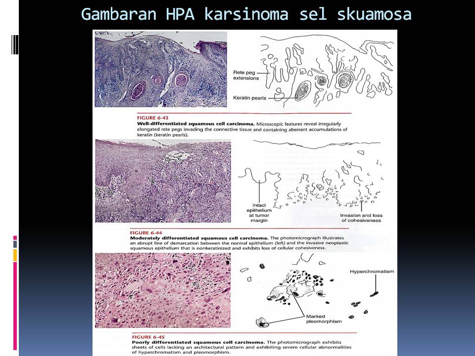 KEDOKTERAN - KEDOKTERAN GIGI: KANKER LIDAH