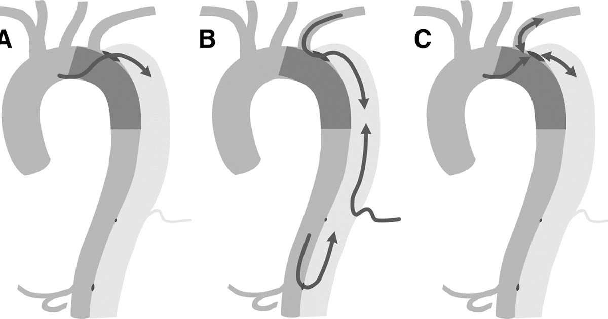 Vascular Mind : TYPES OF ENDOLEAKS IN TEVAR FOR AORTIC DISSECTION