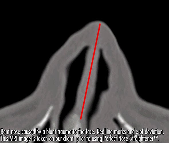 Make nose straight without surgery - a review of