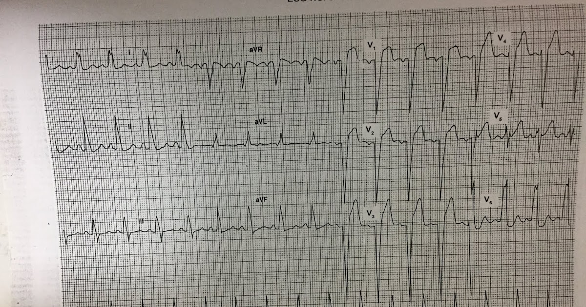 ECG EXERCISE 91,92,93,94