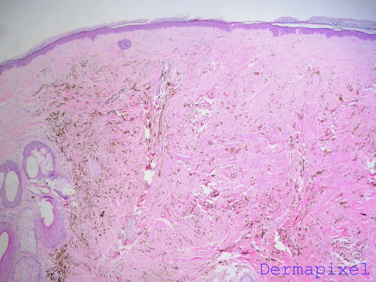 Dermapixel: Cuando los nevus, como los príncipes, son azules