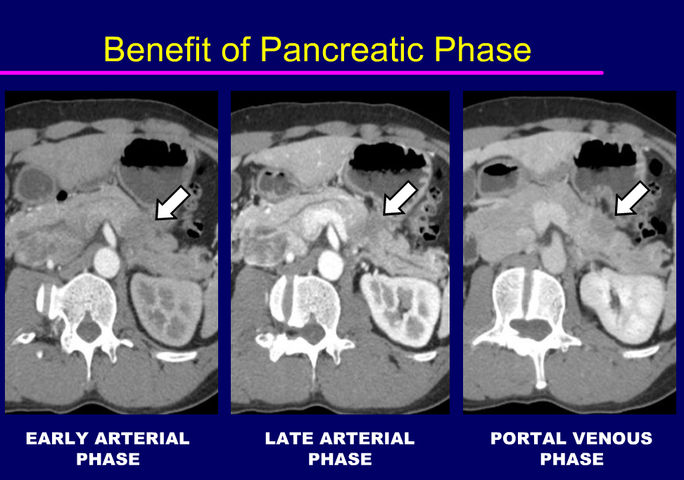 rsna: pancreas imaging