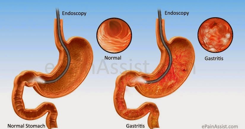 Cara Mencegah Radang Dinding Lambung Secara Alami ~ Cara Mencegah ...
