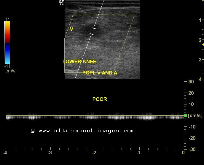 cochinblogs: Ultrasound imaging of popliteal vein thrombosis