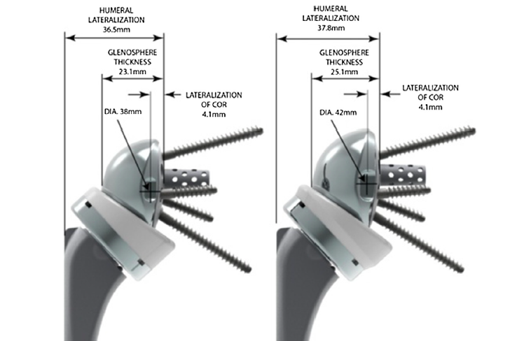 UW Shoulder and Elbow Academy: Reverse total shoulder - does glenophere ...
