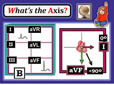 ECG Interpretation: ECG Blog #203 (ECG MP-20,21) — AXIS & Hemiblocks ...