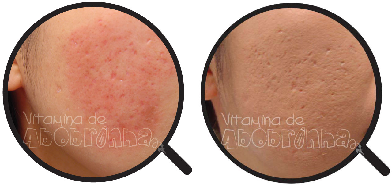Vitamina de Abobrinha: Peeling médio - solução de jessner e ATA 35%