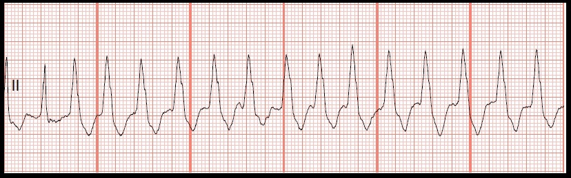 EKG Rhythm Strip Quiz 138