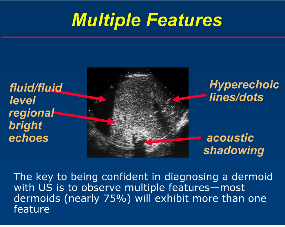 Rsna Dermoidcystic Teratoma