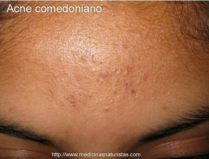 Acné remedios caseros - Jorge Valera: Acné Comedoniano