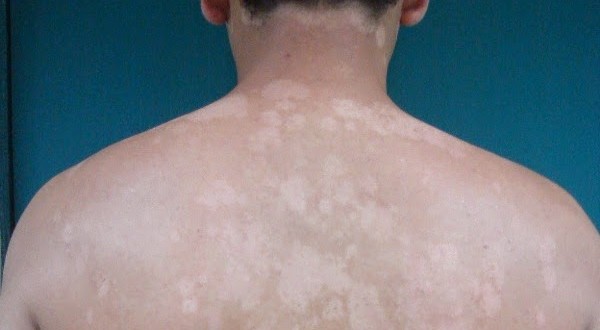 Blog Kesehatan: Penyakit Panu : Pengertian, Gejala, Penyebab, Cara ...