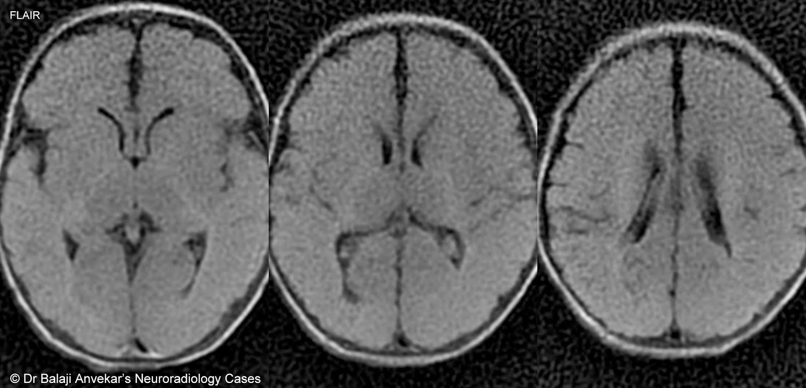 Dr Balaji Anvekar FRCR: Germinal matrix hemorrhage MRI Brain