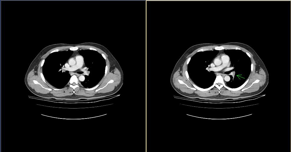 CXR 胸部x光判讀 pulmonary embolism