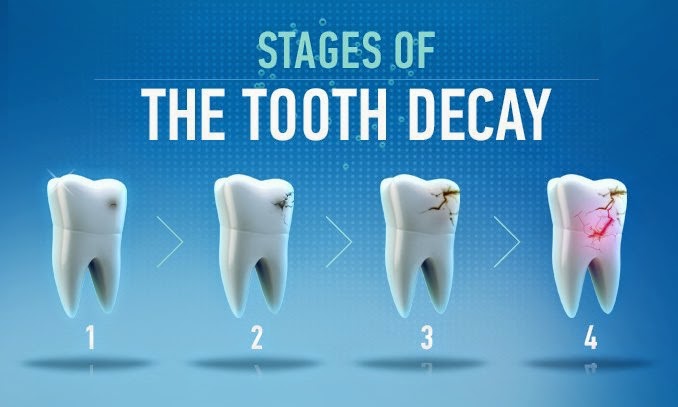 Tooth Decay Stages | Dental Dentist