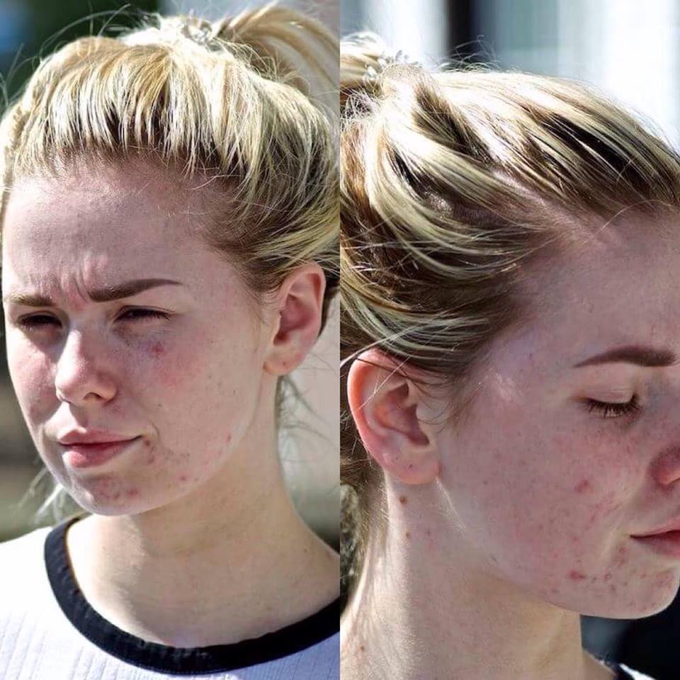 Jodi Roche Makeup: Micro-needling: My first session!