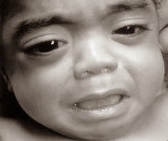 Medical Treatment Pictures-for Better Understanding: Hurler Syndrome ...