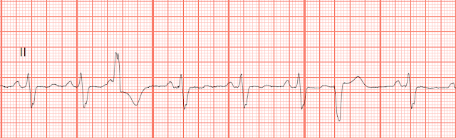 EKG Quiz 352