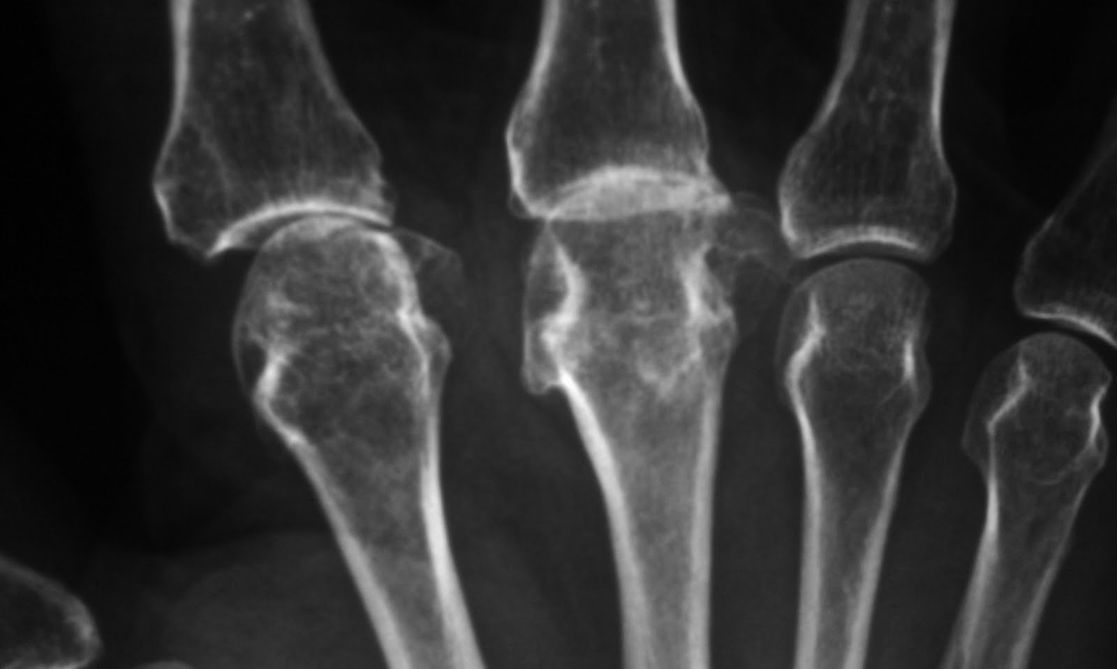 Daily Dose: Osteoarthritis of second and third metacarpophalangeal joints