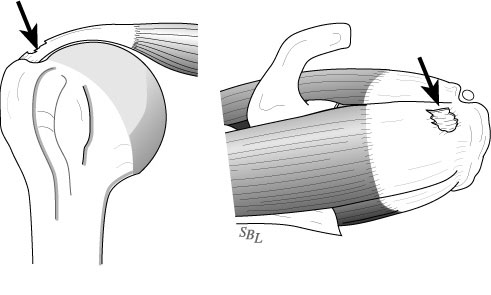 UW Shoulder and Elbow Academy: Rotator Cuff 3 - Patterns of tearing