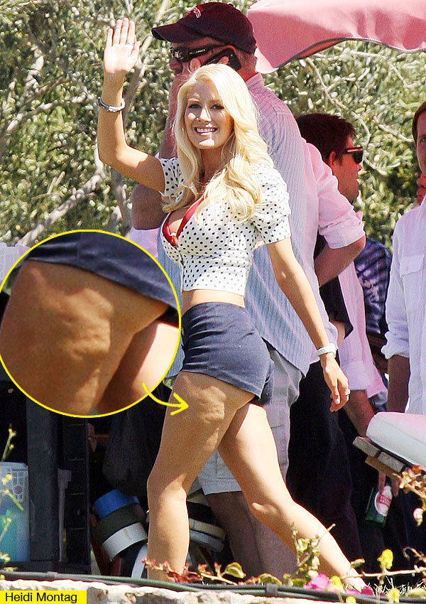 Cellulite Treatment Reviews: Blake Lively Cellulite