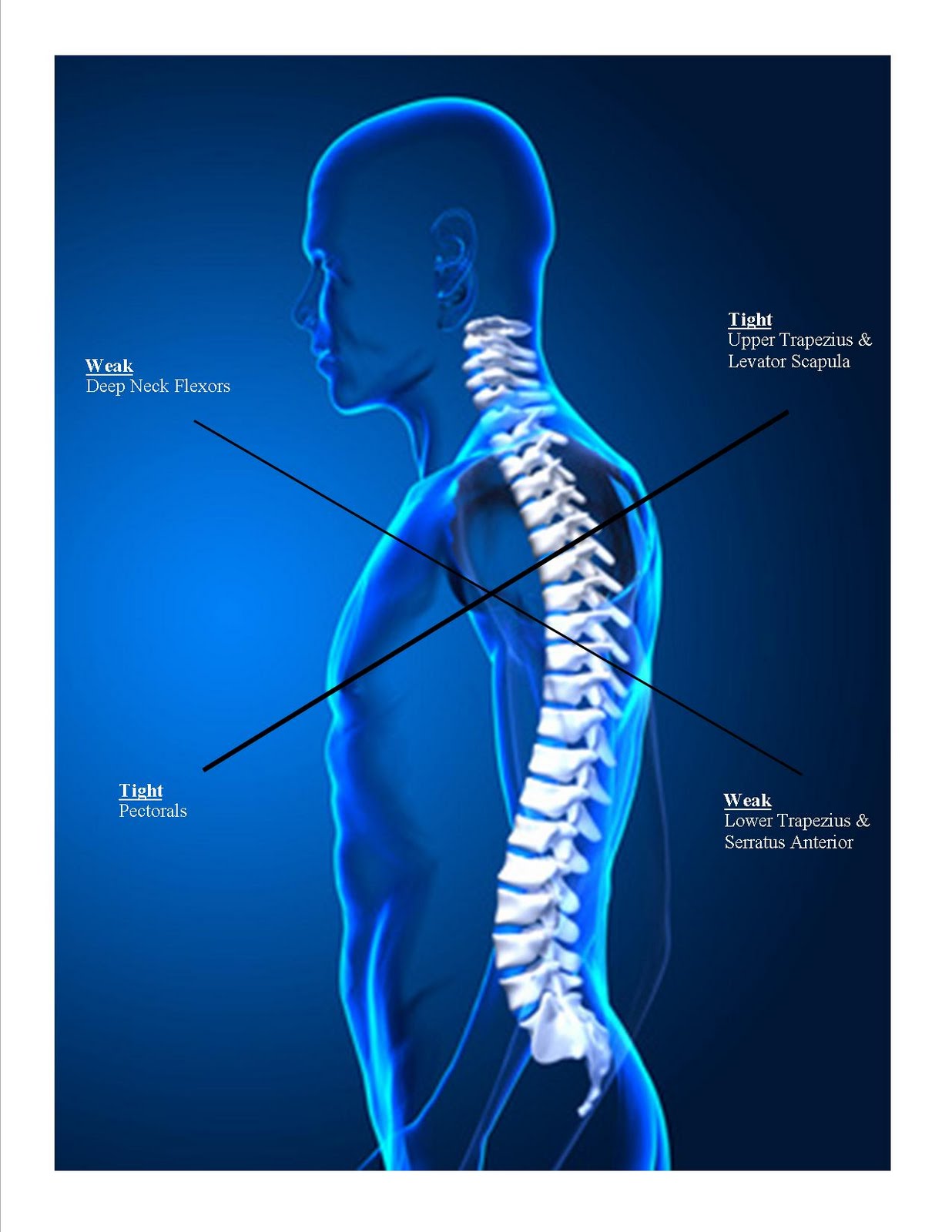 Dr. Bryon's Health Blog: Upper Crossed Syndrome