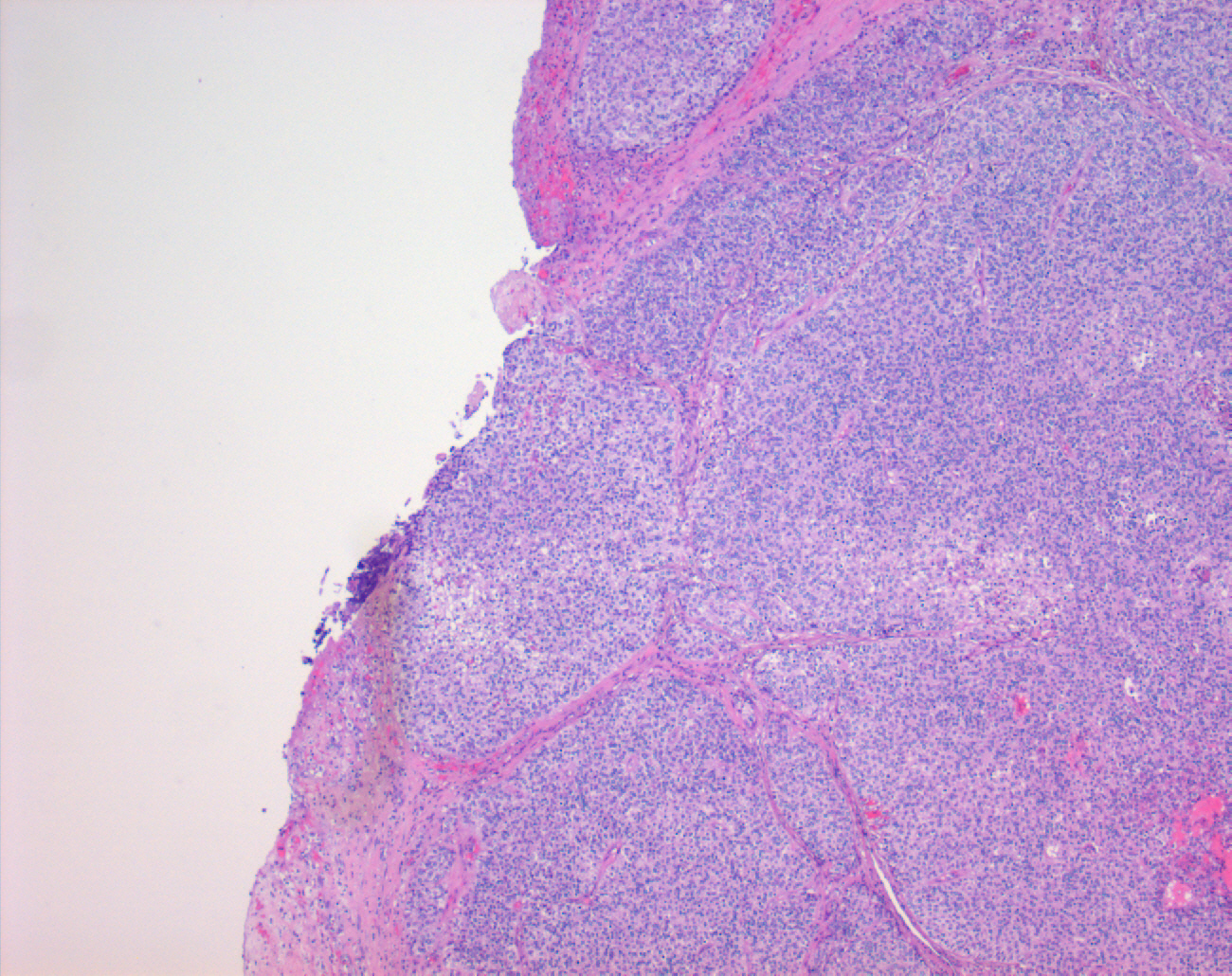 Cancer: Urethral Cancer