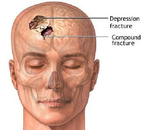 Neuro Operations: Craniocerebral Injuries