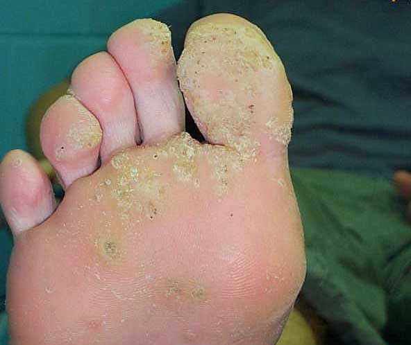 Photos of Plantar Warts ~ How To Remove Moles, Warts, Skin Tags Safely