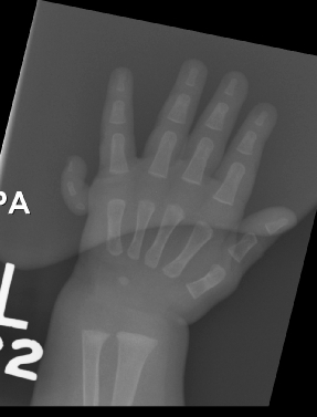 Extra Digits | Congenital Hand and Arm Differences | Washington ...