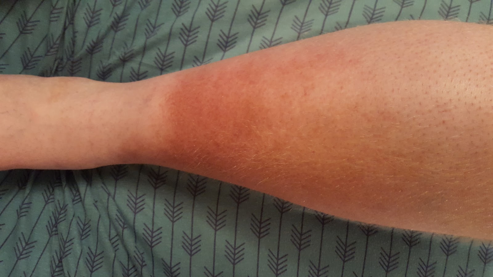 BubbaMike's Ramblings: Cellulitis (warning, graphic photos in this post)