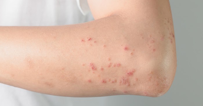 New STD is Spread .. Hundreds of People Are Already Infected - Wise Thinks