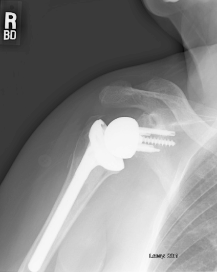 Shoulder and Elbow Surgery: Reverse shoulder replacement for cuff tear ...