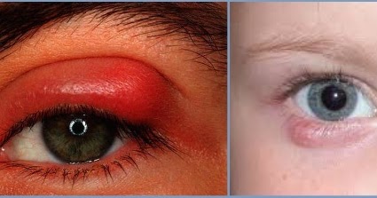 Eyelid Bump: Symptoms, Causes and Treatments | Nurselk.com