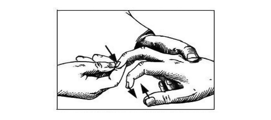 Acurácia Diagnóstica do Sinal de Hoffmann ~ Fisionerds