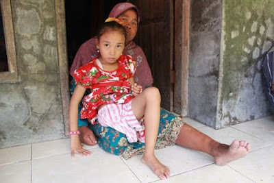 Cacat Mental Dan Fisik | Tales