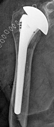 UW Shoulder and Elbow Academy: The humeral component - importance of ...