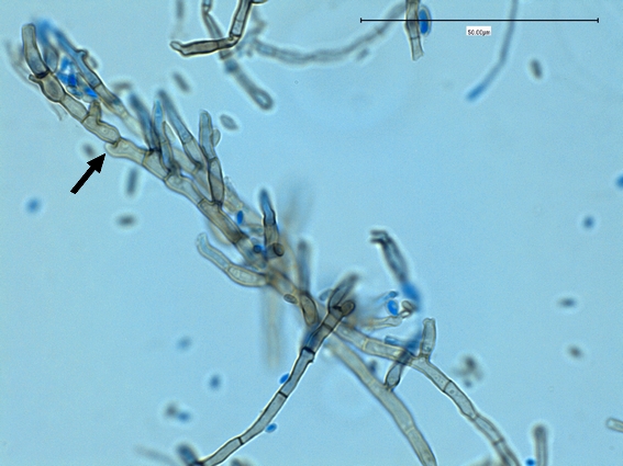 Fun With Microbiology (What's Buggin' You?): Fonsecaea pedrosoi/monophora