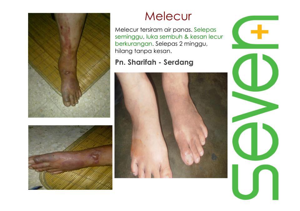 azizshoppe: TESTIMONI PESAKIT KULIT MELECUR