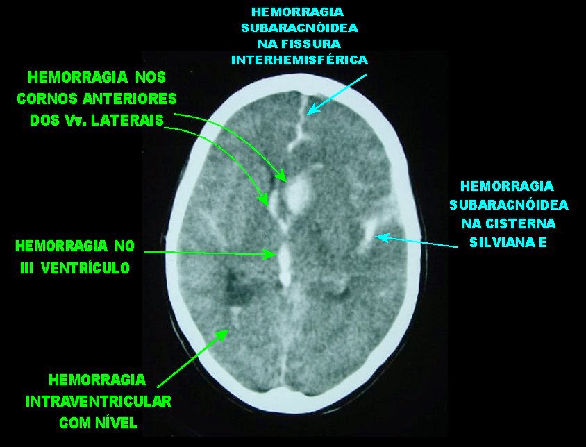 Liga Paraibana de Neurointensivismo: Escala Fisher - Análise da ...