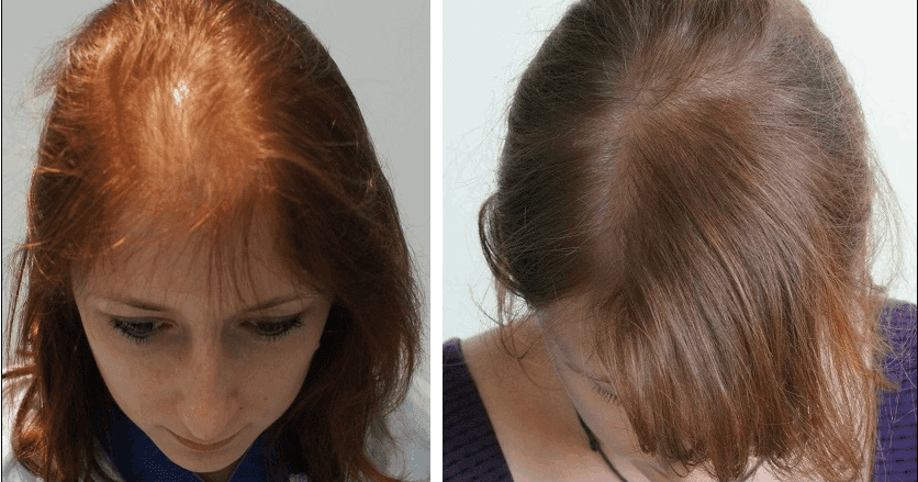 The Technique FUE And How Does It Work: How Is A FUE Surgery Performed