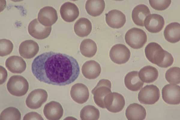 VETERINARY HEMATOLOGY DEXTERVET: plasmacytoid reactive lymphocyte ...