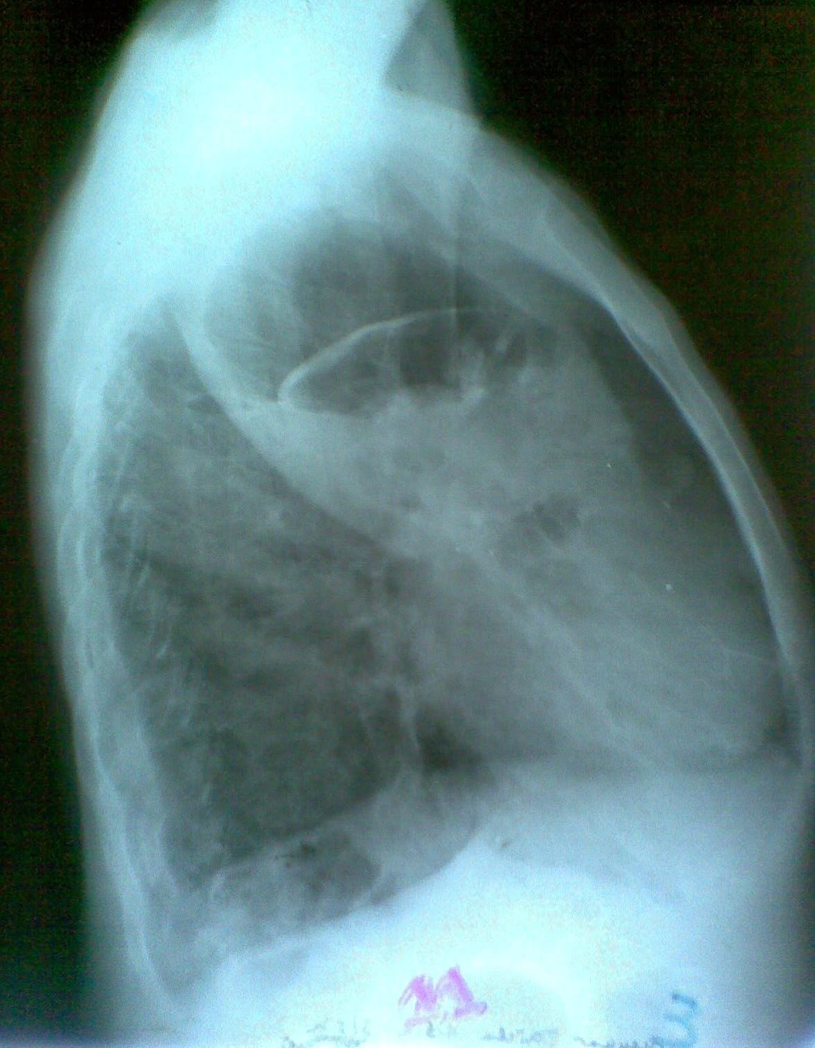 Telethorax