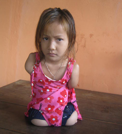 KI Media: Limbless girl seeks help