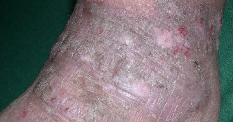 Pengobatan Penyakit Neurodermatitis Secara Alami - Rekomendasi Obat ...