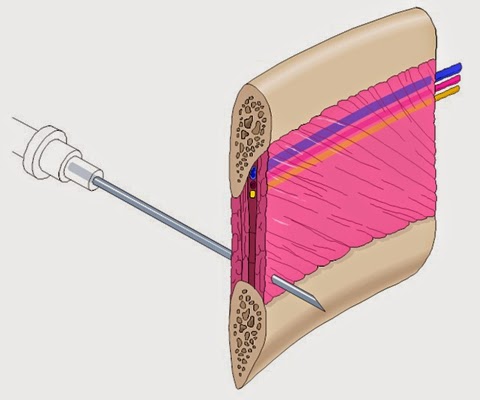 Adult Emergency Medicine: Tension Pneumothorax