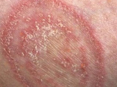 Symptomen van Candida-infectie die is belangrijk voor ons om te weten