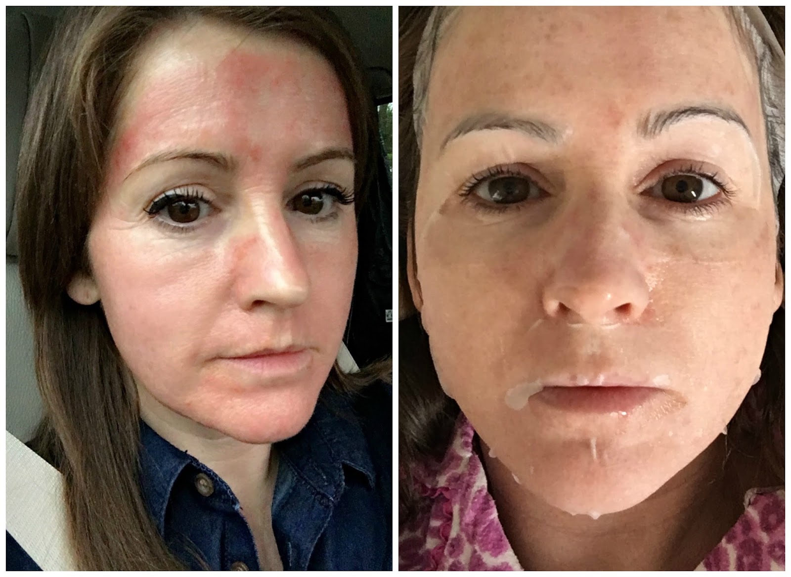 Collagen PIN || Medizen Clinic | Priceless Life Of Mine